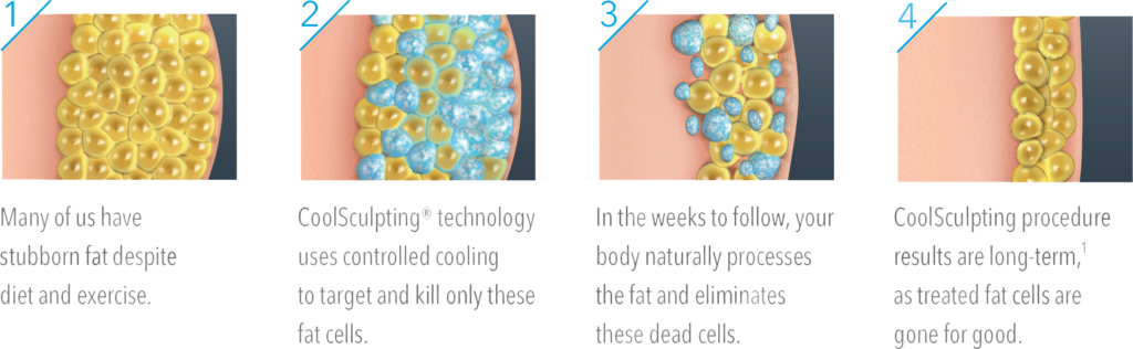 Coolsculpting | Prestige Medical Spa